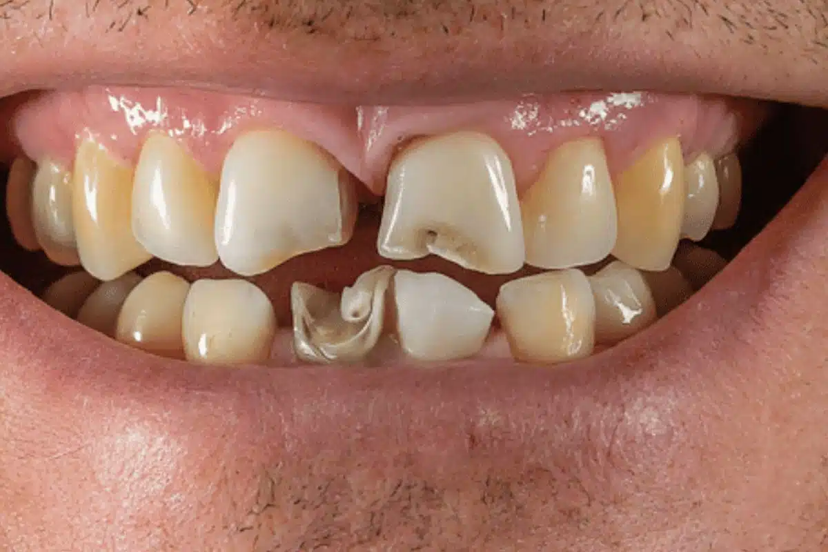 Composite fillings front teeth before and after