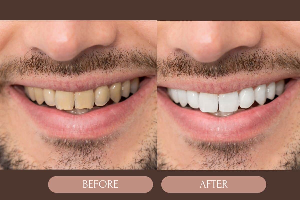 10 Tips for Whitening Teeth in a Day and Maintaining Healthy Gums