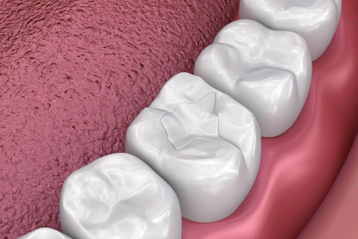 Before and After: Composite Fillings for Receding Gums