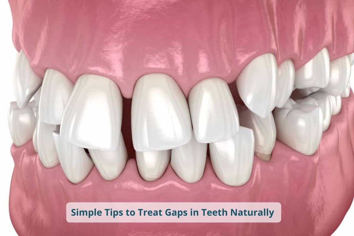 10 Simple Tips to Treat Gaps in Teeth Naturally